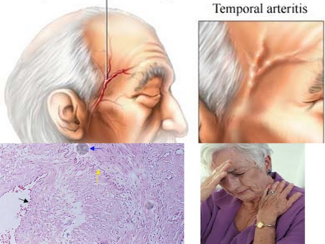 Arterite De Celulas Gigantes Arteritis De Células Gigantes, Aortitis